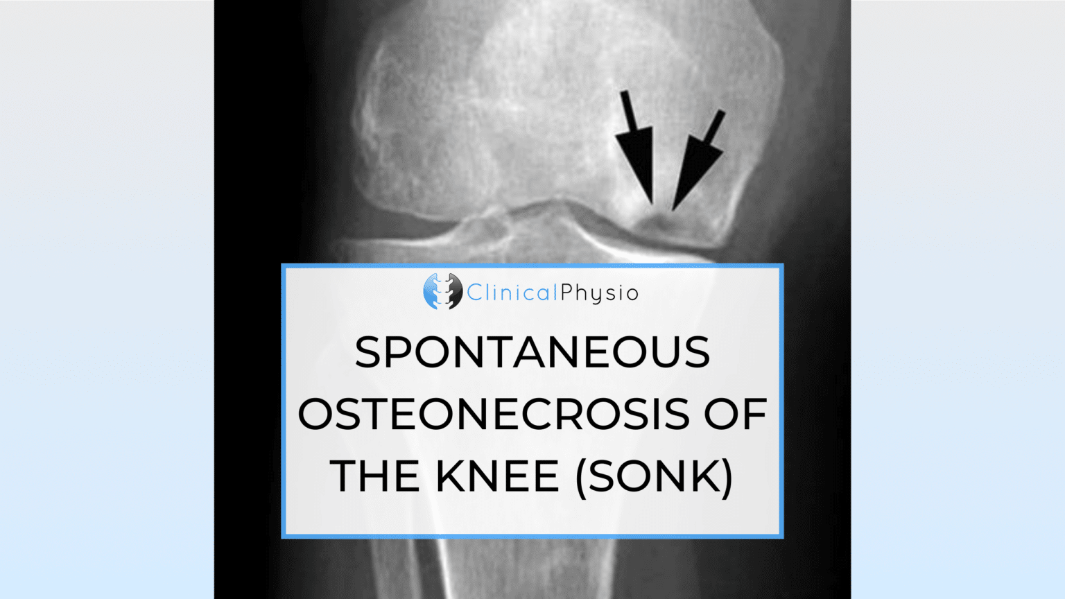 Spontaneous Osteonecrosis of the Knee – Clinical Physio Membership