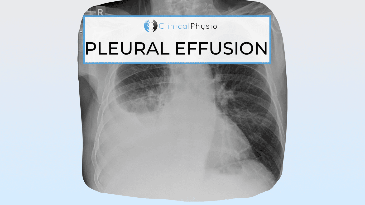 Pleural Effusion – Clinical Physio Membership