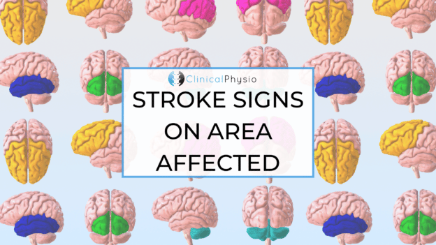 Stroke Signs In Different Brain Regions – Clinical Physio Membership