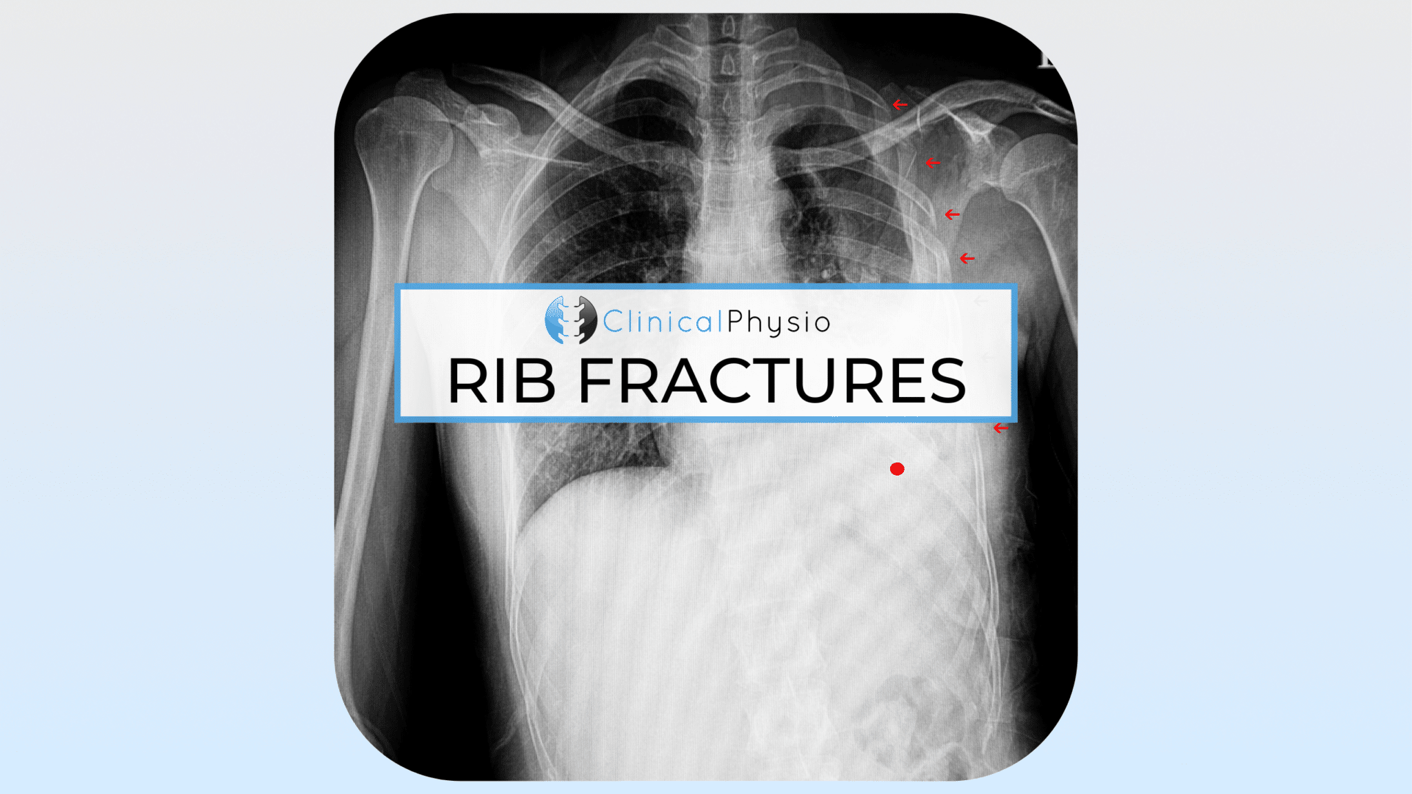 Rib Fractures – Clinical Physio Membership