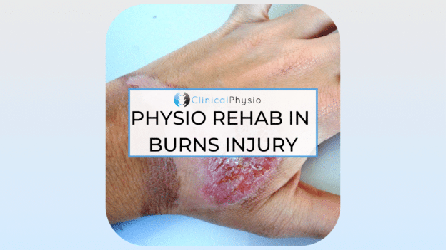 Role of Physio in Recovery from Burns Injury – Clinical Physio Membership