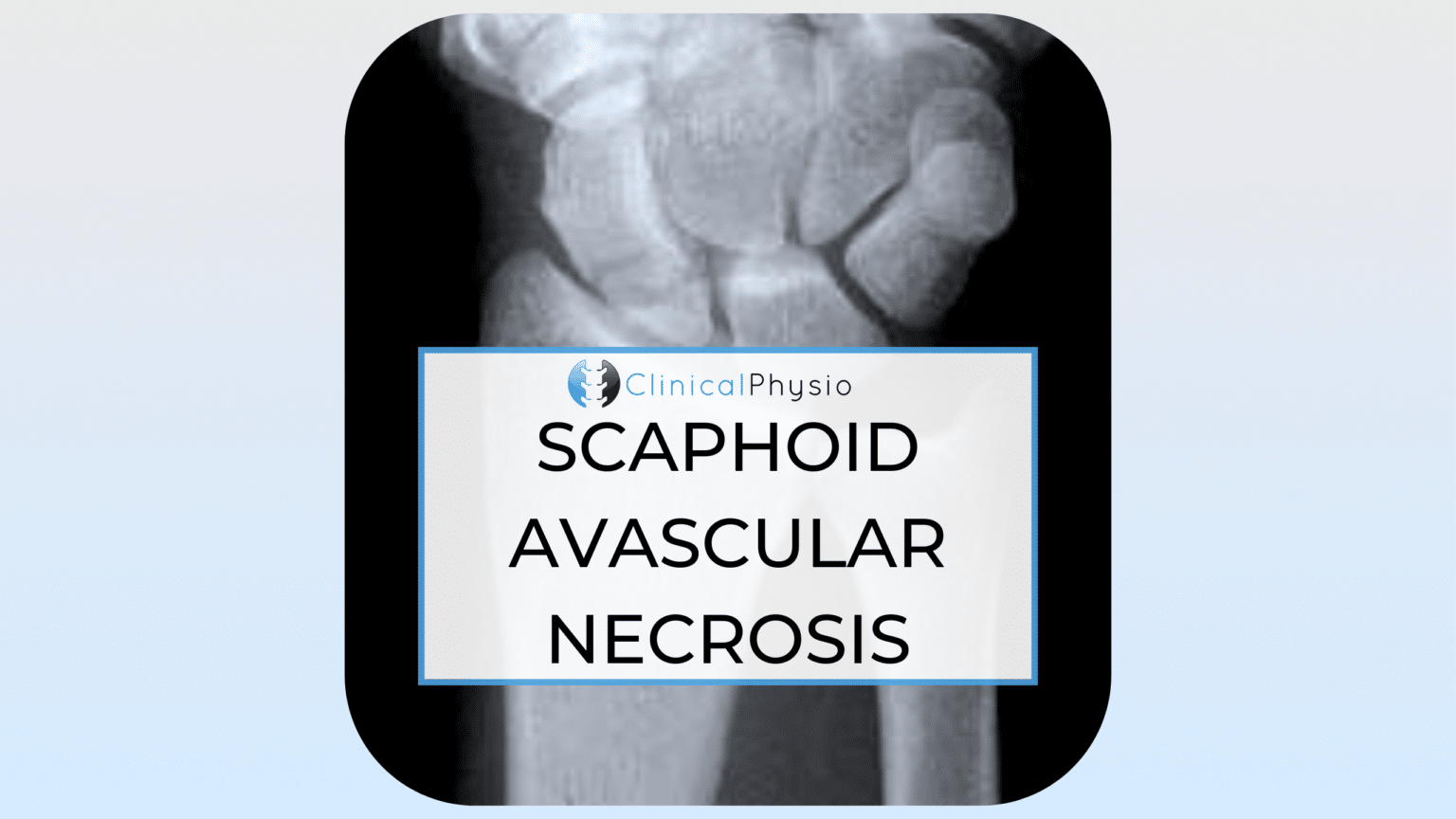 Scaphoid Avascular Necrosis – Clinical Physio Membership