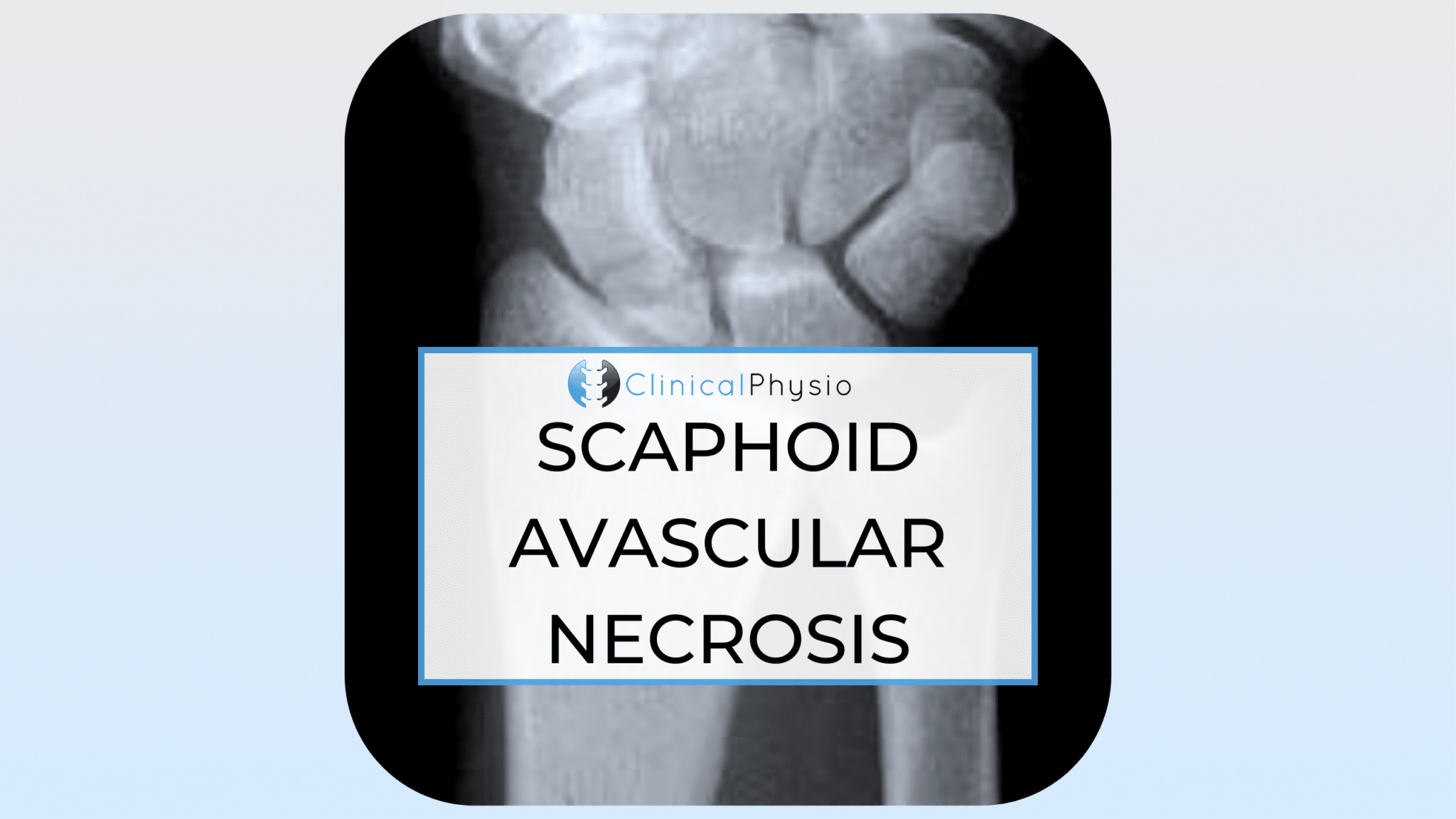 Scaphoid Avascular Necrosis – Clinical Physio Membership