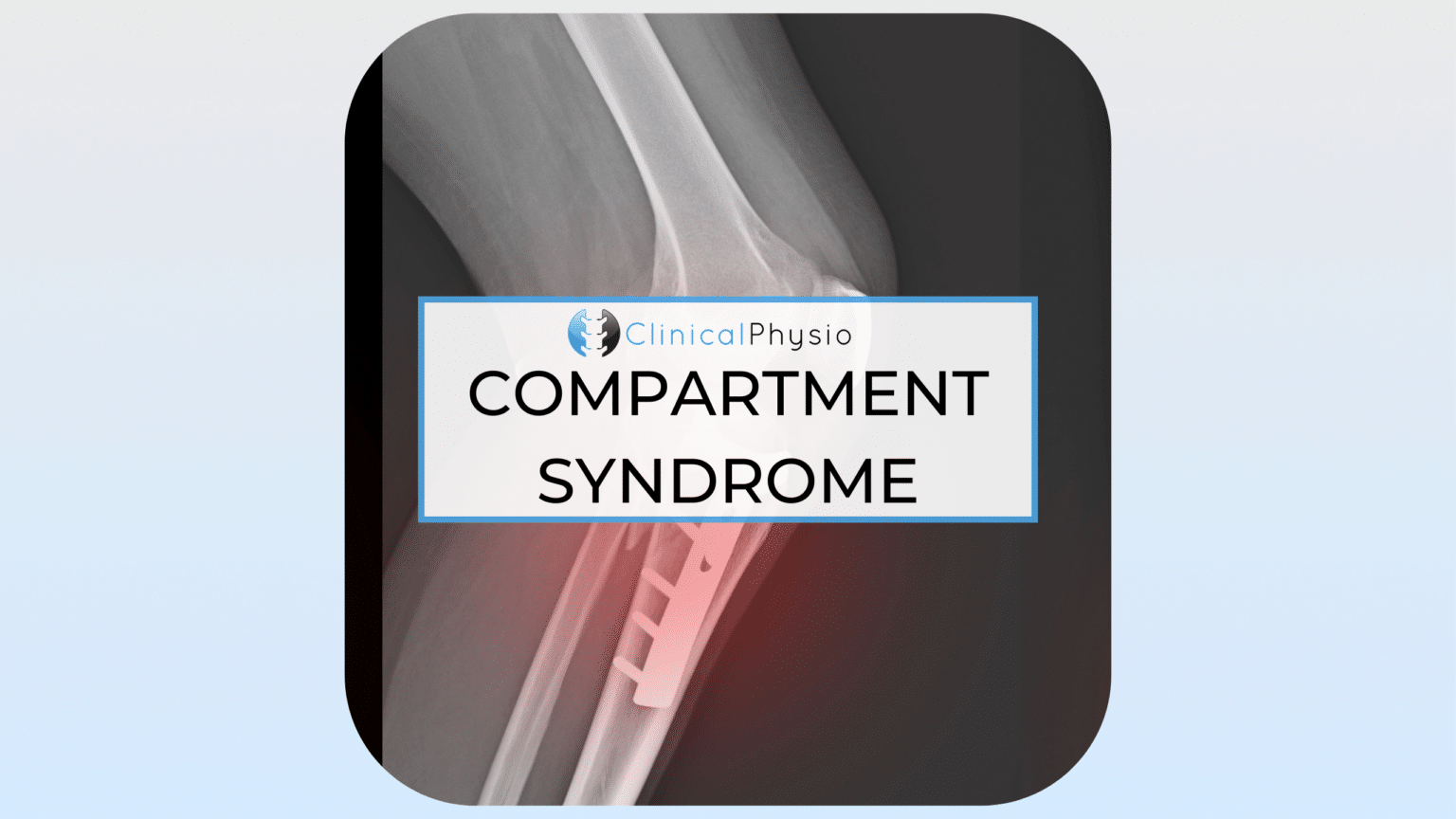 Compartment Syndrome – Clinical Physio Membership