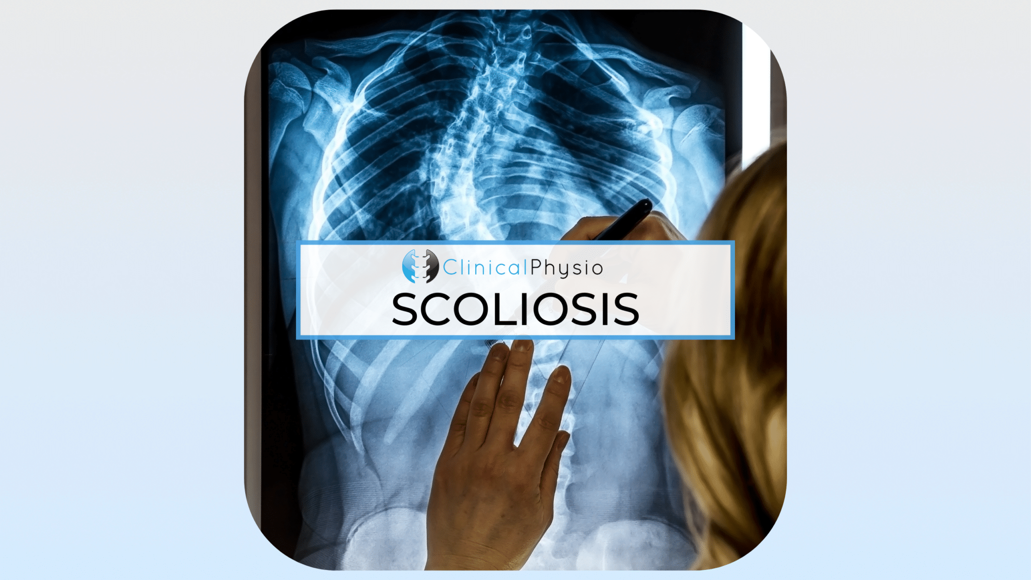 Scoliosis – Clinical Physio Membership