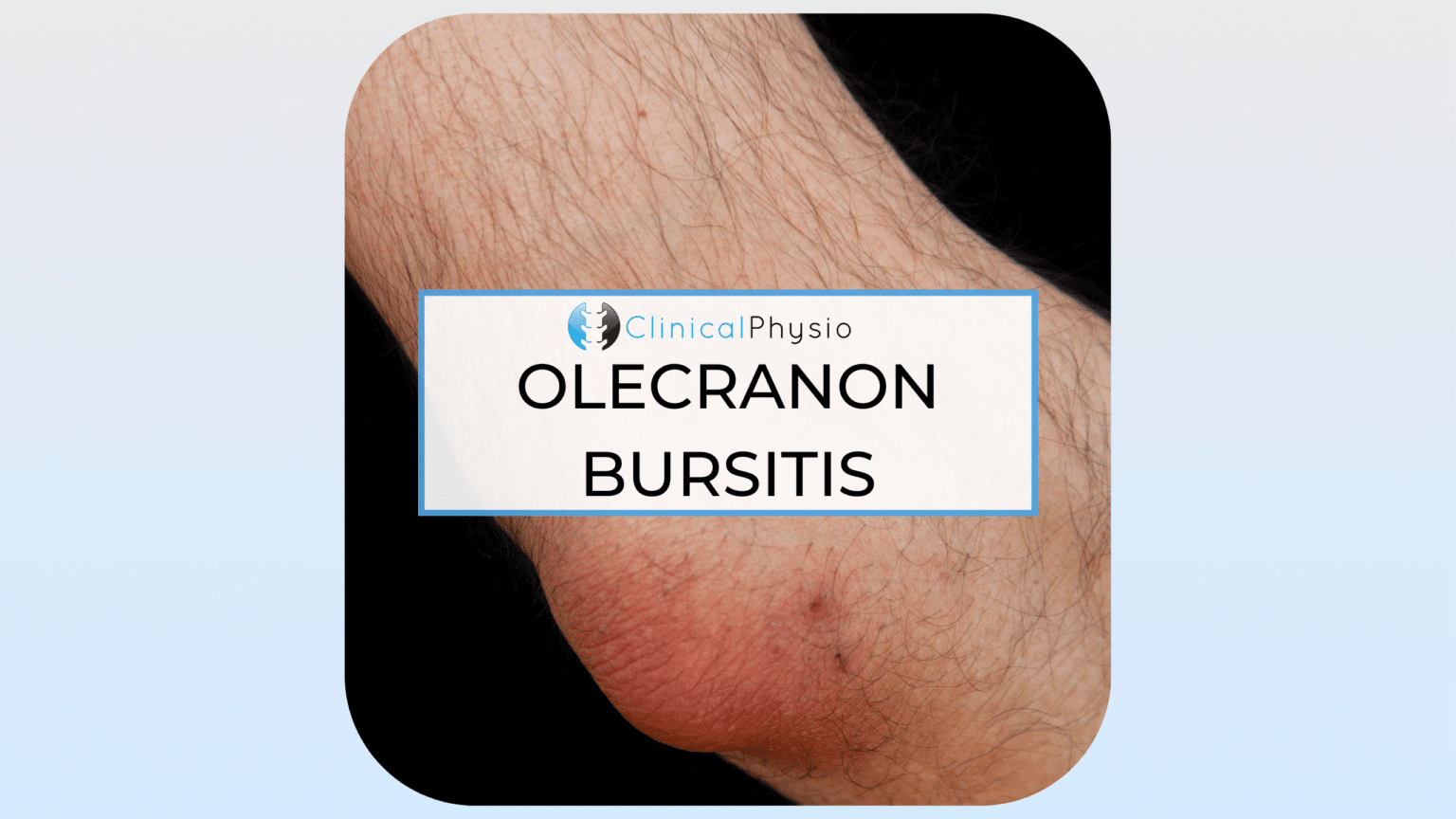 Olecranon Bursitis – Clinical Physio Membership