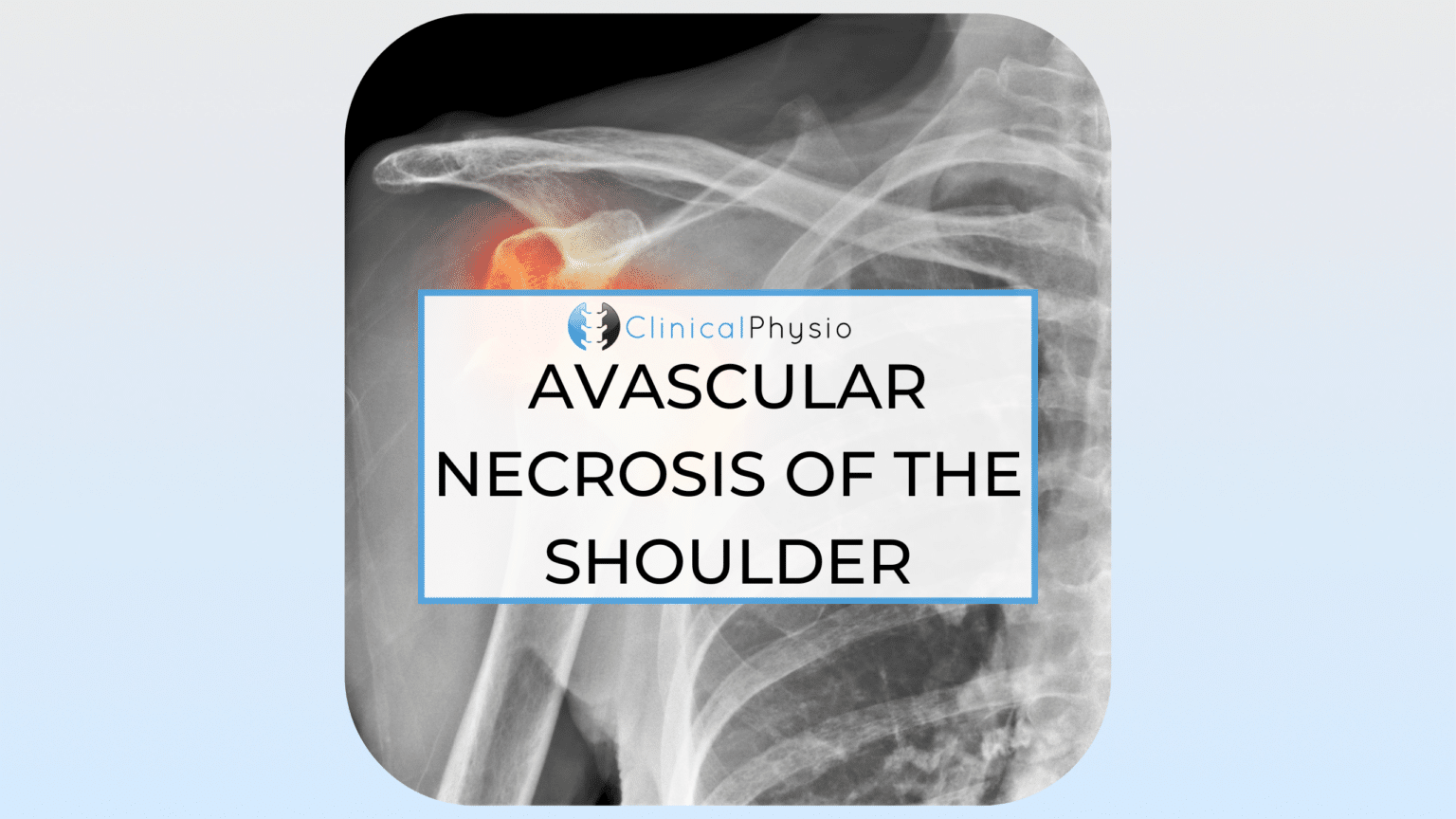 Avascular Necrosis of the Shoulder – Clinical Physio Membership