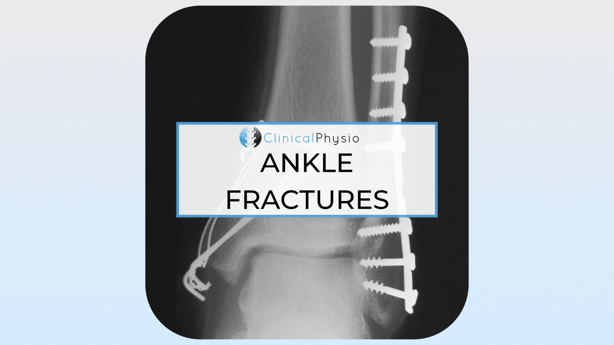 Ankle Fractures – Clinical Physio Membership