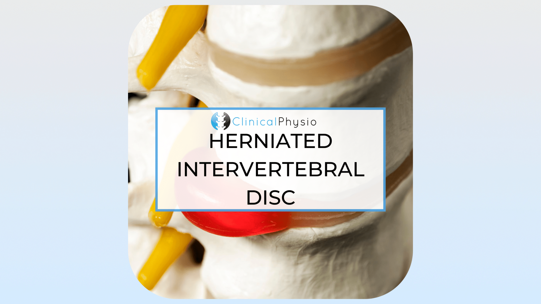 Herniated Intervertebral Disc – Clinical Physio Membership