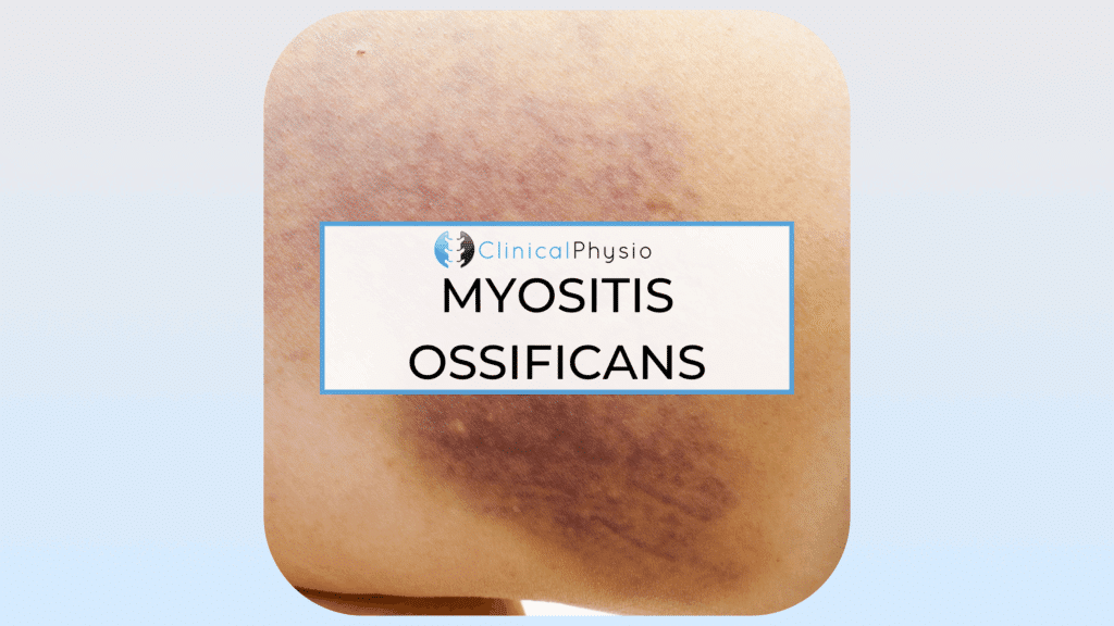 Myositis Ossificans – Clinical Physio Membership