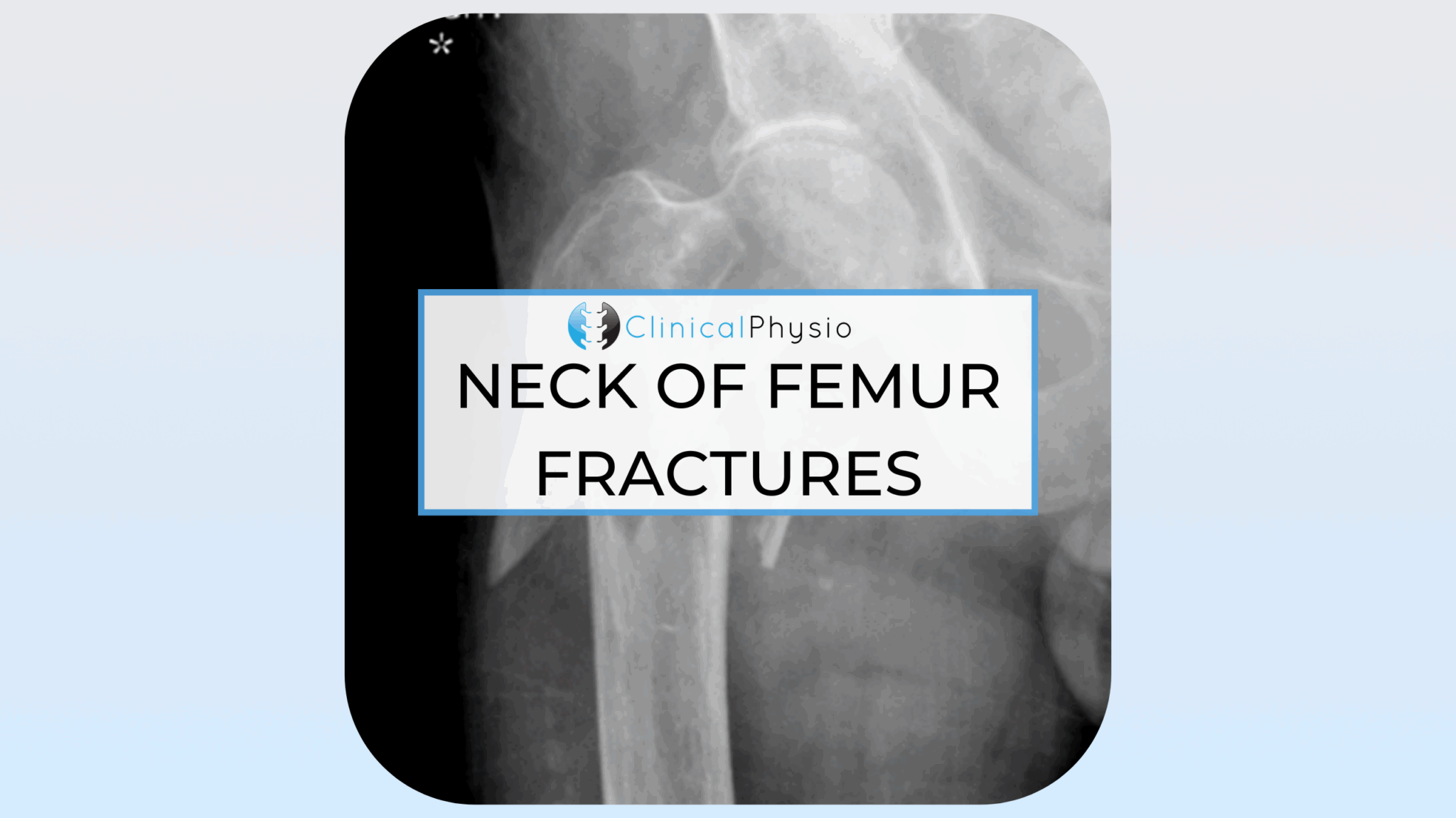 Neck of Femur Fractures – Clinical Physio Membership