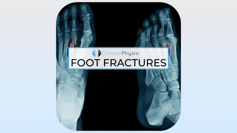 Foot Fractures – Clinical Physio Membership